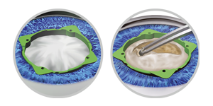 BVI I-Ring Pupil Expander